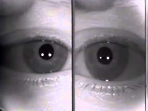 Downbeat Nystagmus 2 6 Youtube