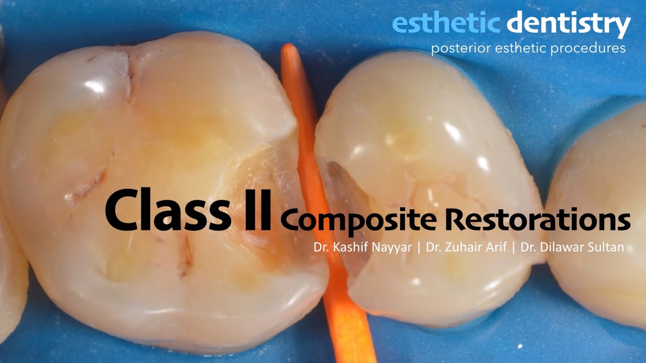 Class Ii Composite Restorations Youtube