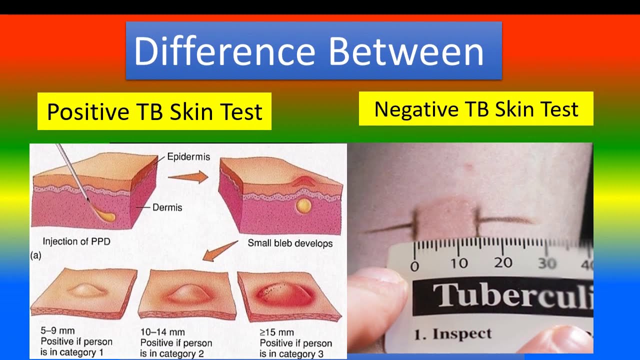 Difference Between Positive Tb Skin Test And Negative Tb Skin Test