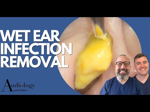 Ear Infection Removal Ep870 Youtube