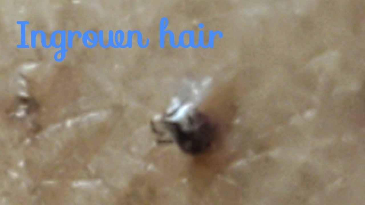 Removing Ingrown Hairs Youtube