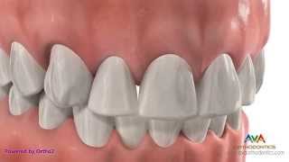 Interproximal Reduction Or Ipr Disc Doovi