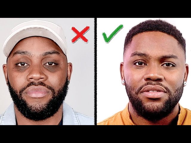 What Causes Dark Circles Under Eyes In Men Infoupdate Org