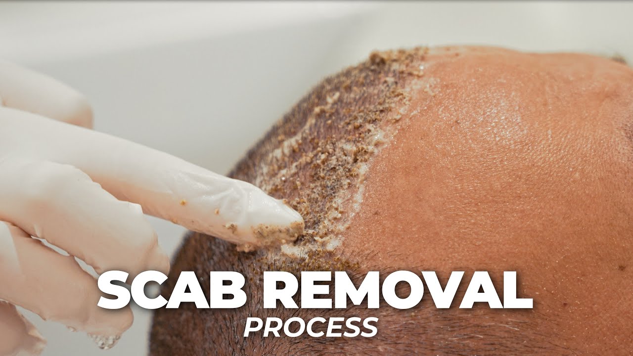 Scab Removal Process Explained Youtube