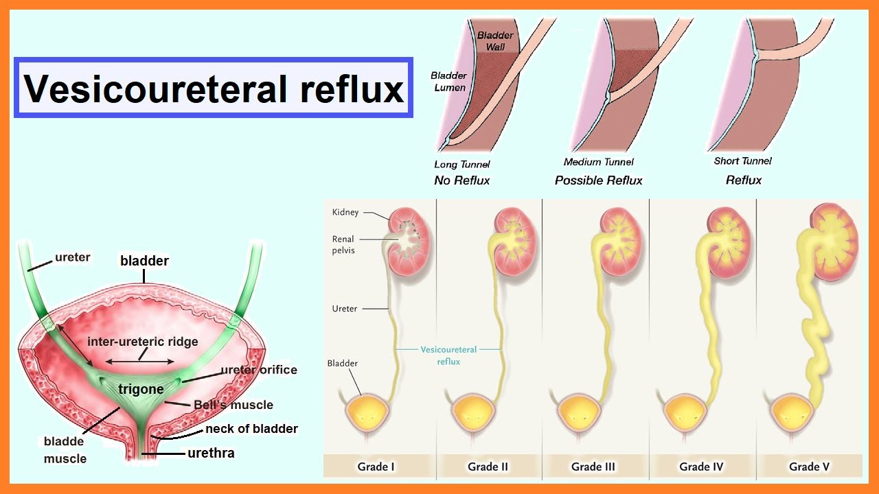 Vesicoureteral Reflux Vur Understanding Vur Grade 3 And It S Treatment