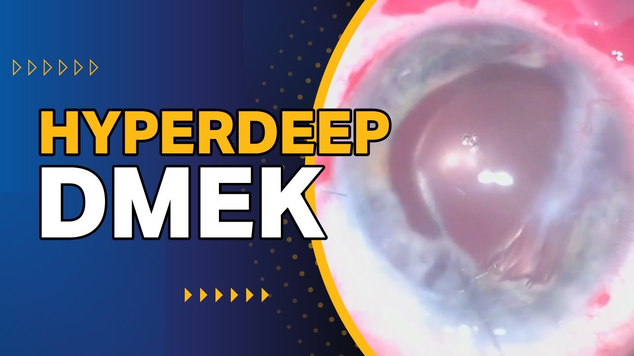 Hyperdeep Dmek Youtube