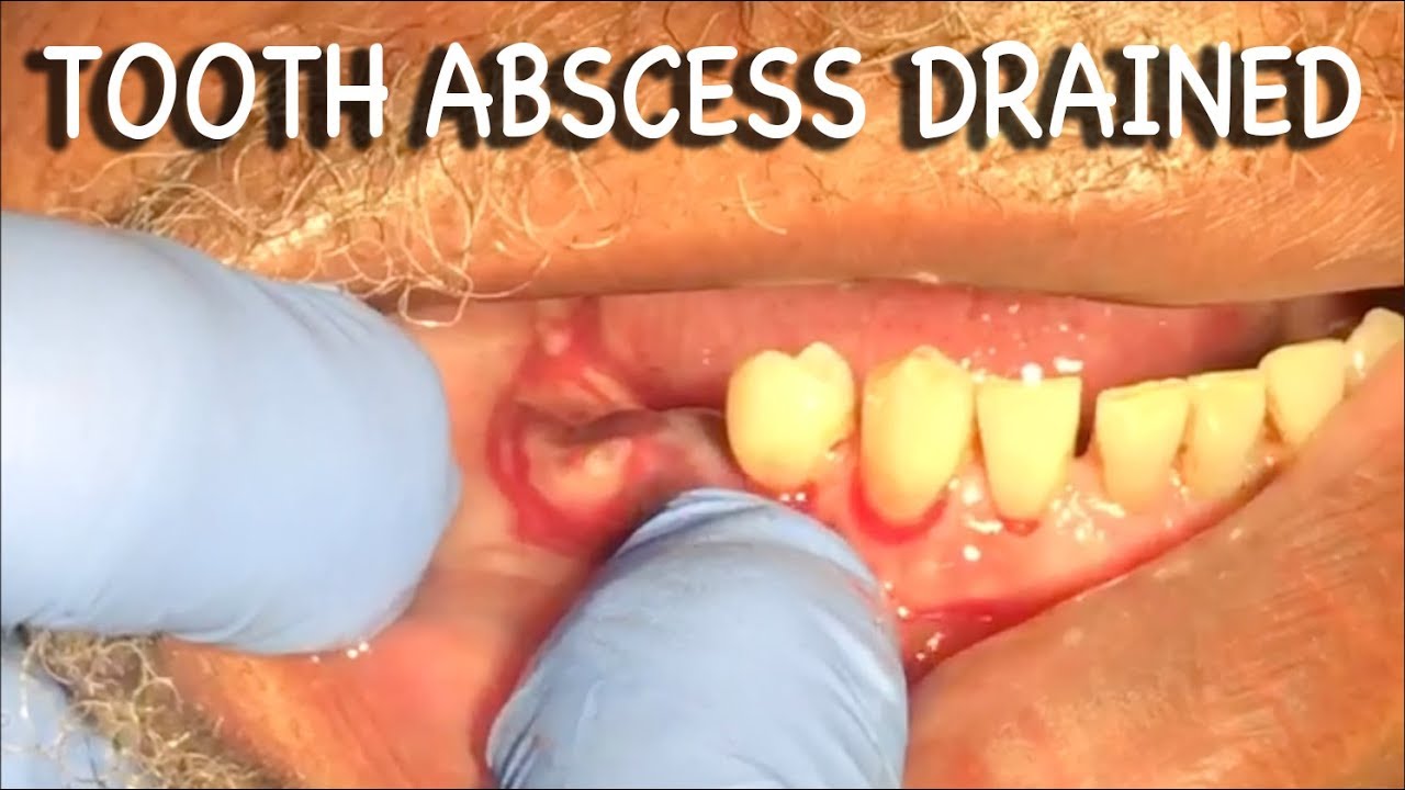 Tooth Abscess Drain