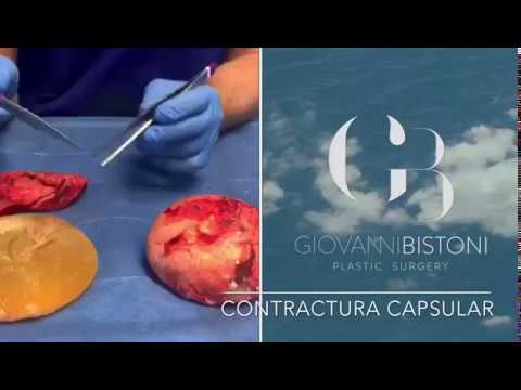Contractura Capsular Recambio De Protesis Mamaria En Valencia Youtube
