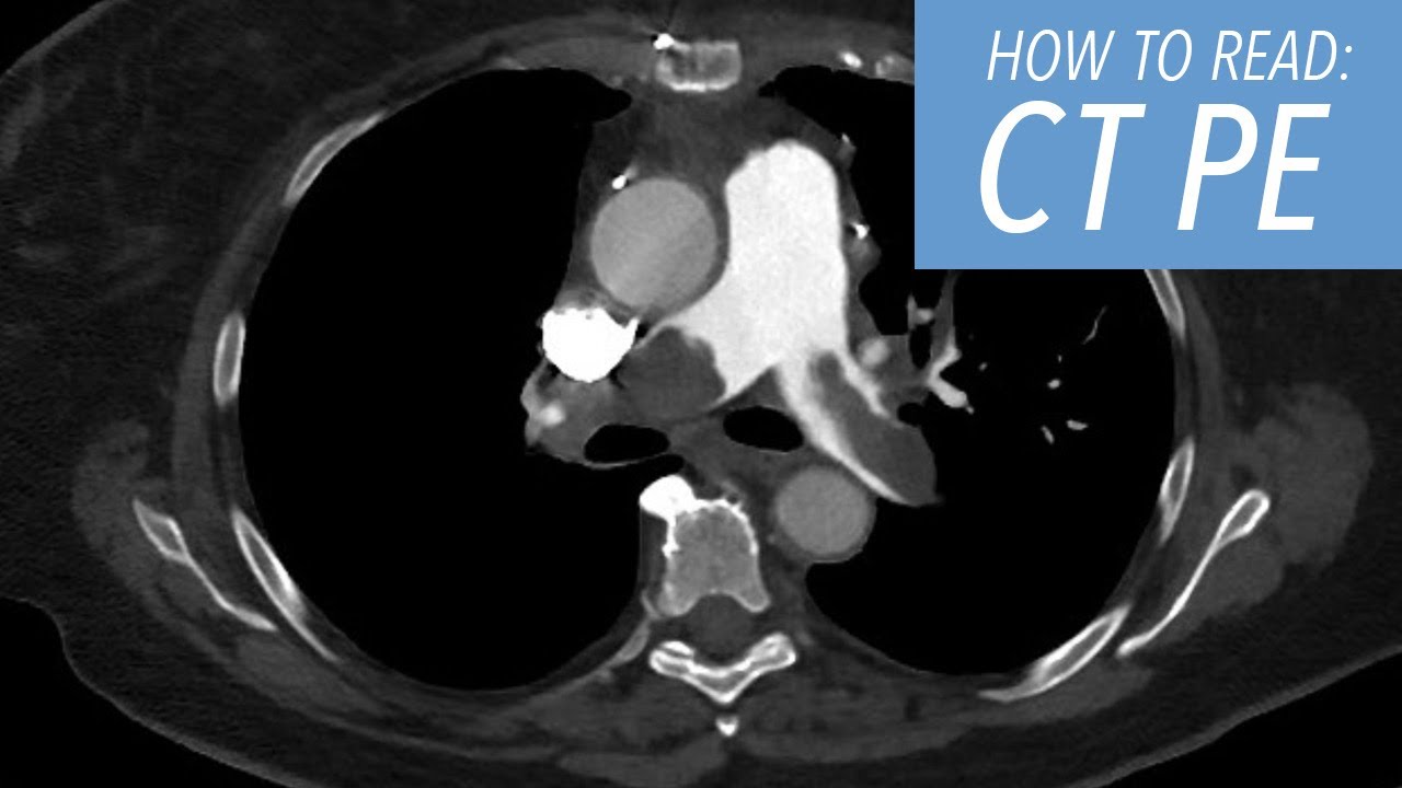What Does A Pulmonary Embolism Look Like On A Ct Scan