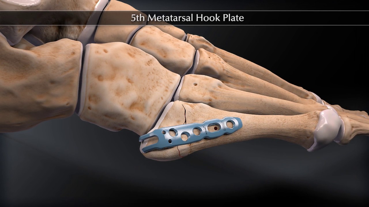 Base Of 5th Metatarsal Fracture Splint At Jasper Rae Blog