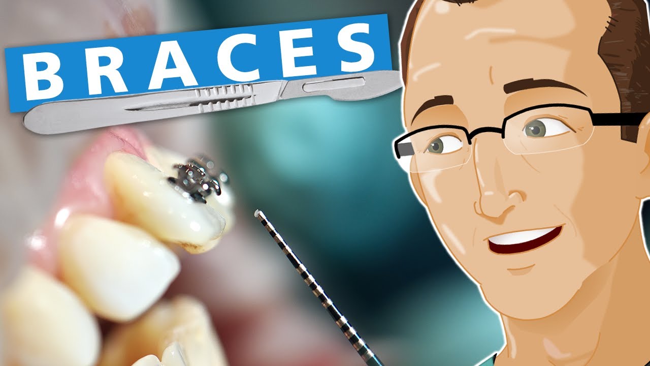 Braces Youtube