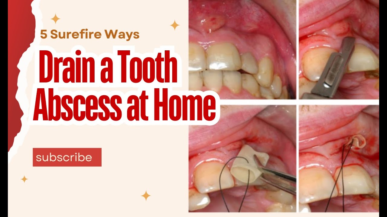 How To Drain A Tooth Abscess At Home Naturally 5 Surefire Ways Youtube