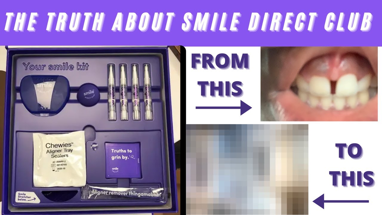 The Truth About Smile Direct Club My Personal Experience Pictures