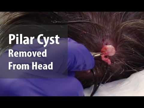 Pilar Cyst Removal Dr Derm Youtube