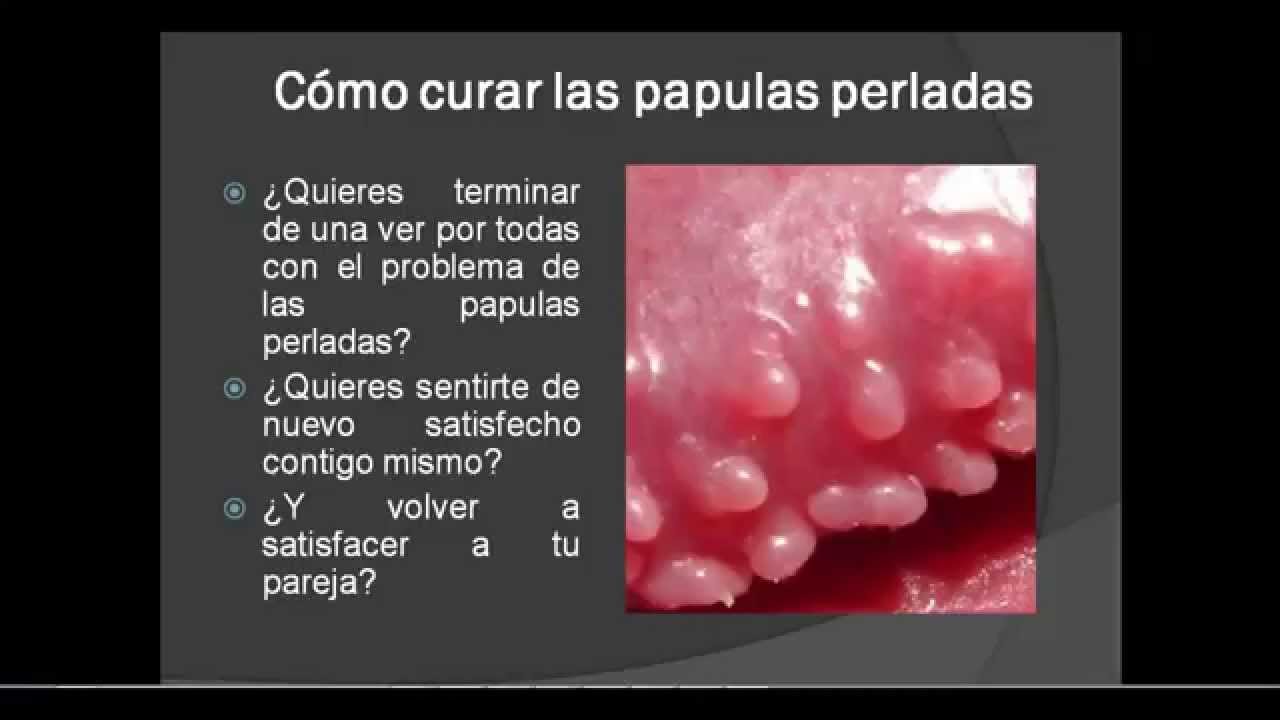 La Cura De Las Papulas Perladas Youtube