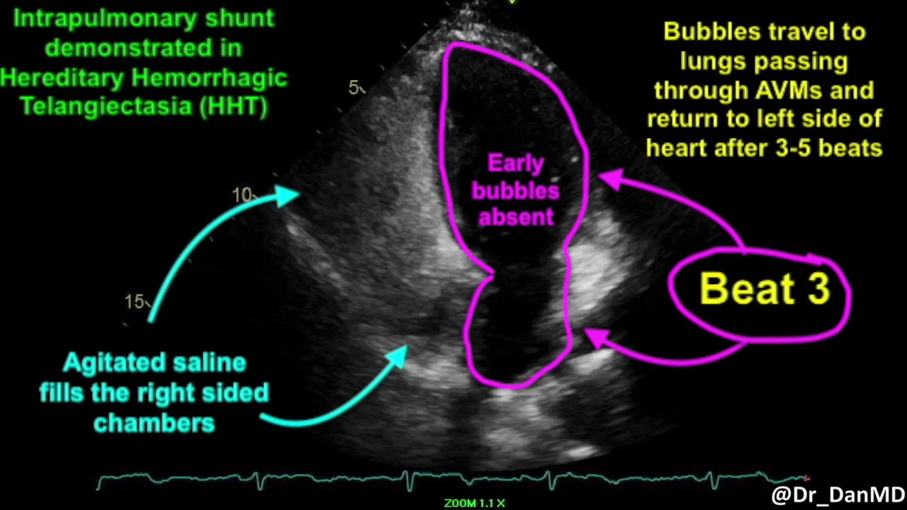 Pulmonary Arteriovenous Malformations Avms In Hht Youtube