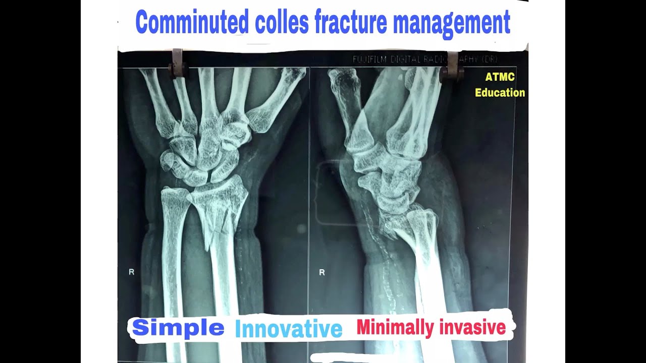 What Is A Colles Fracture Of The Wrist At Ryan Shipp Blog