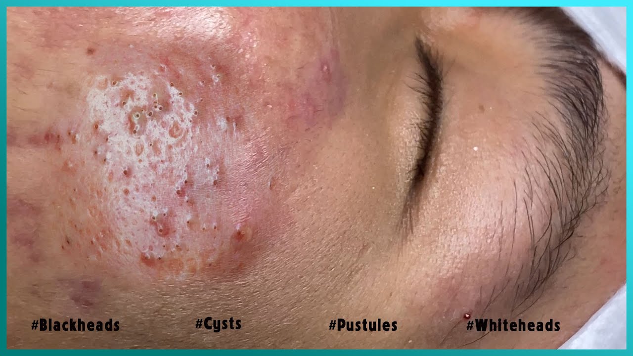 Big Cystic Acne Blackheads Extraction Blackheads Milia Whiteheads