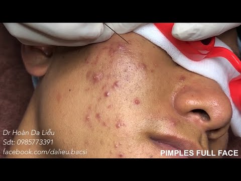Dermatologist Treating Squeeze Pimples Whitehead Blackhead Pustule