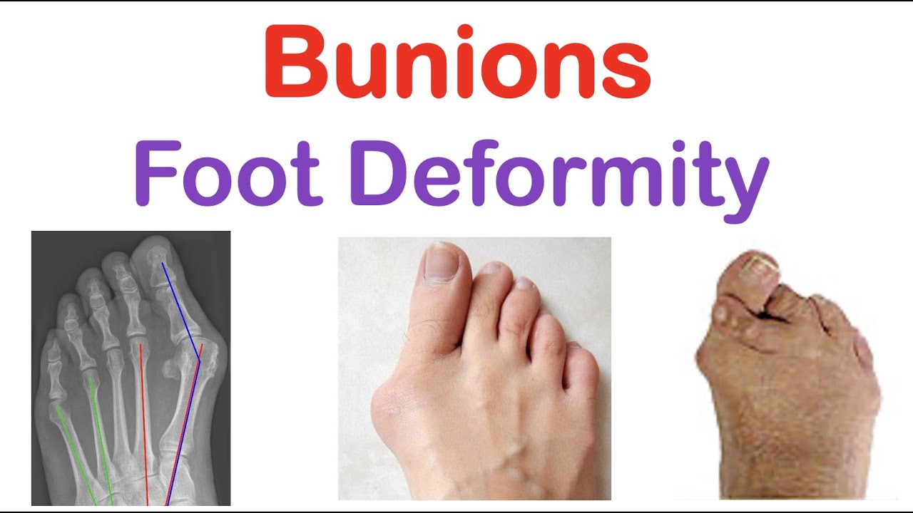 Bunions Foot Deformity Types Bunionettes Risk Factors
