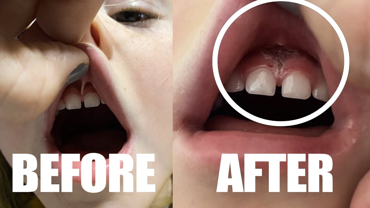 Three Year Old Gets Surgery Lip Tie Lasered At The Dentist Youtube