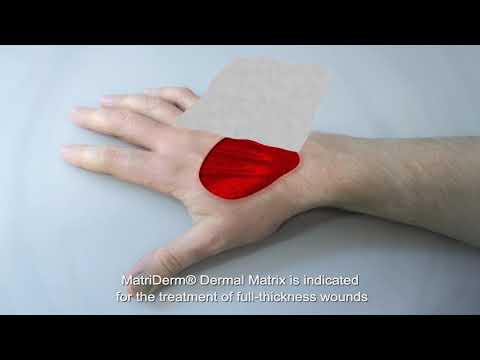 Matriderm Dermal Matrix Application Youtube