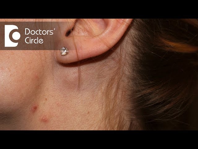 What Causes Swollen Lymph Nodes Behind The Ear Infoupdate Org