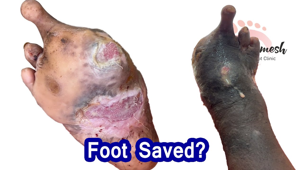 Gangrene Foot Amputation Before After Video Diabeticfoot