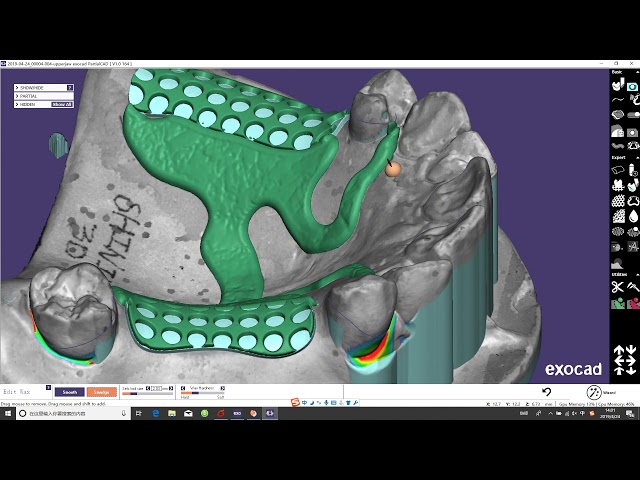 Exocad Crack Partial Framework Softdental