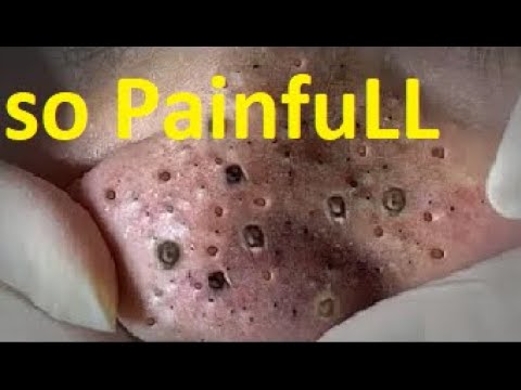 Pimple Popping Removing Blackheads Around Eyes And Mouth Bigger