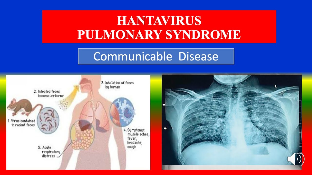 Hantavirus Pulmonary Syndrome Types Causes Pathophysiology