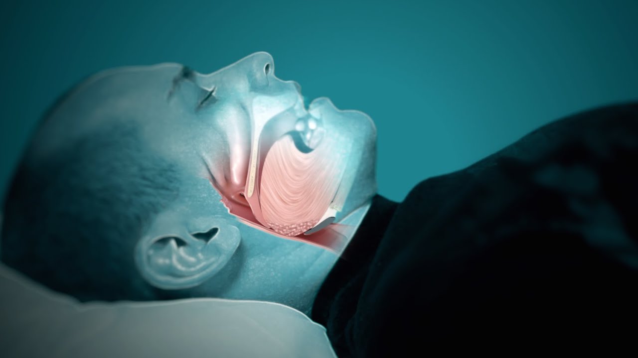 Sleep Apnea Youtube