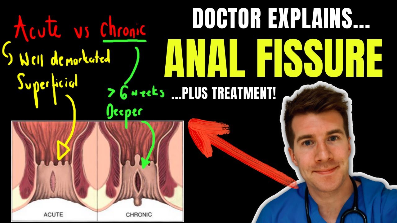 Chronic Anal Fissure