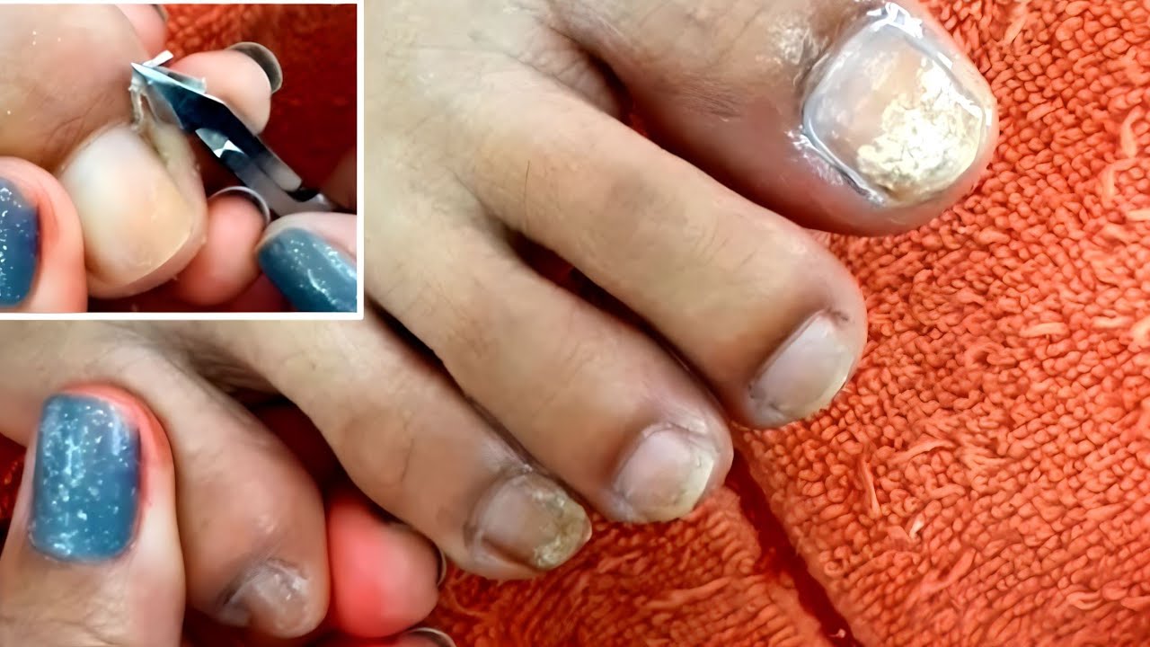 Satisfying Ingrown Toenail Removal Dry Skin Pedicure 103 Youtube