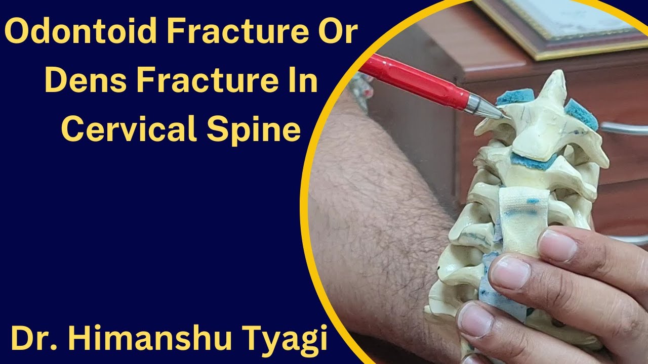 What Is Dens Fracture At Cynthia Cawley Blog