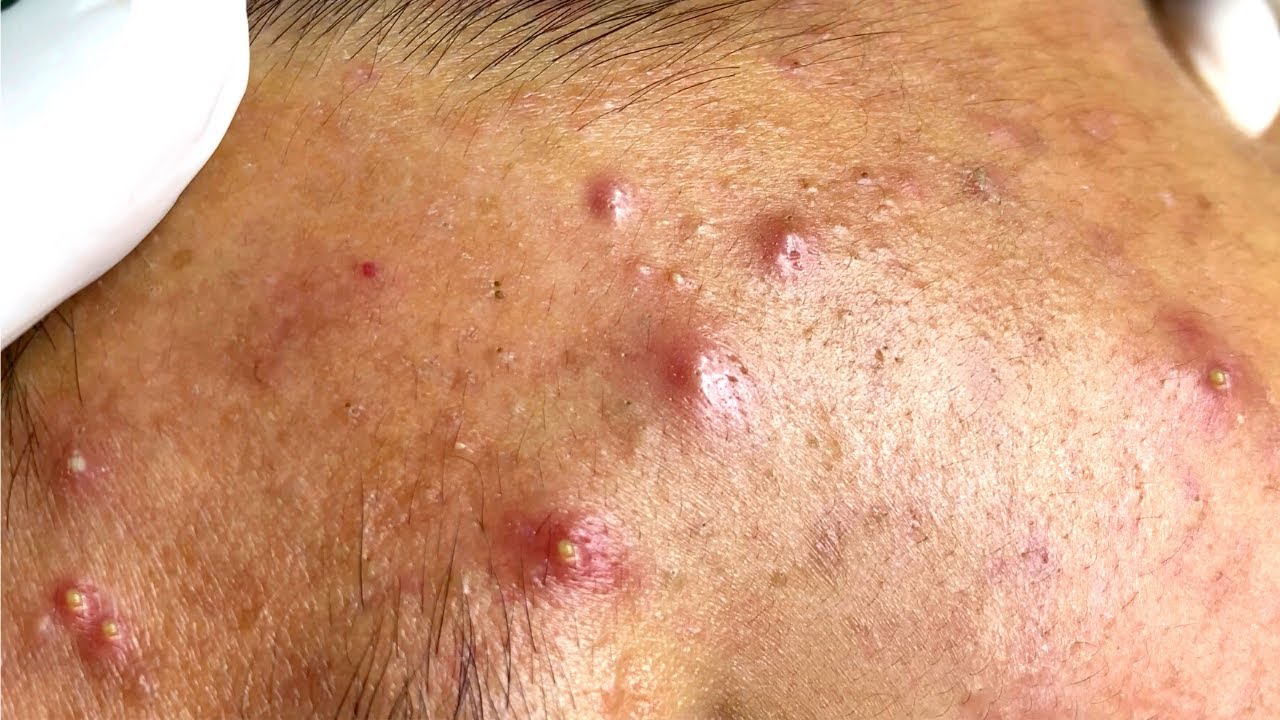 Relax With Massive Cystic Acne Popping Video