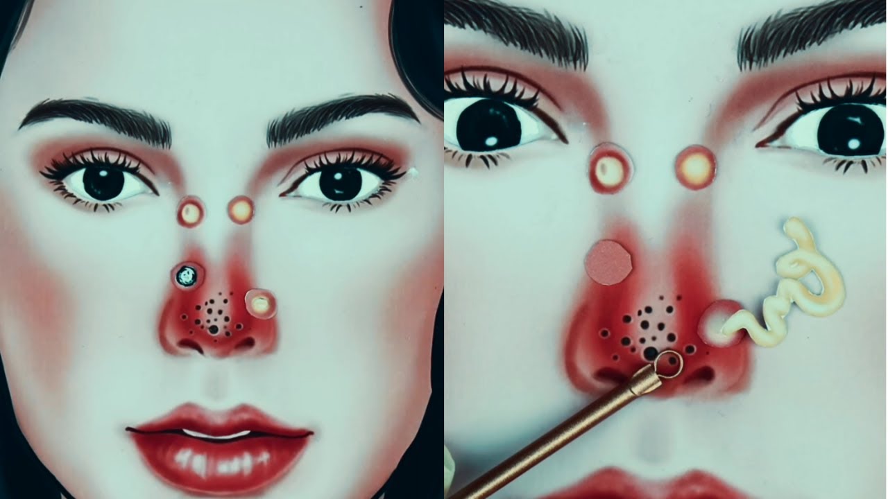 Asmr Remove Nose Blackhead Asmr Treatment Binitaasmr Youtube