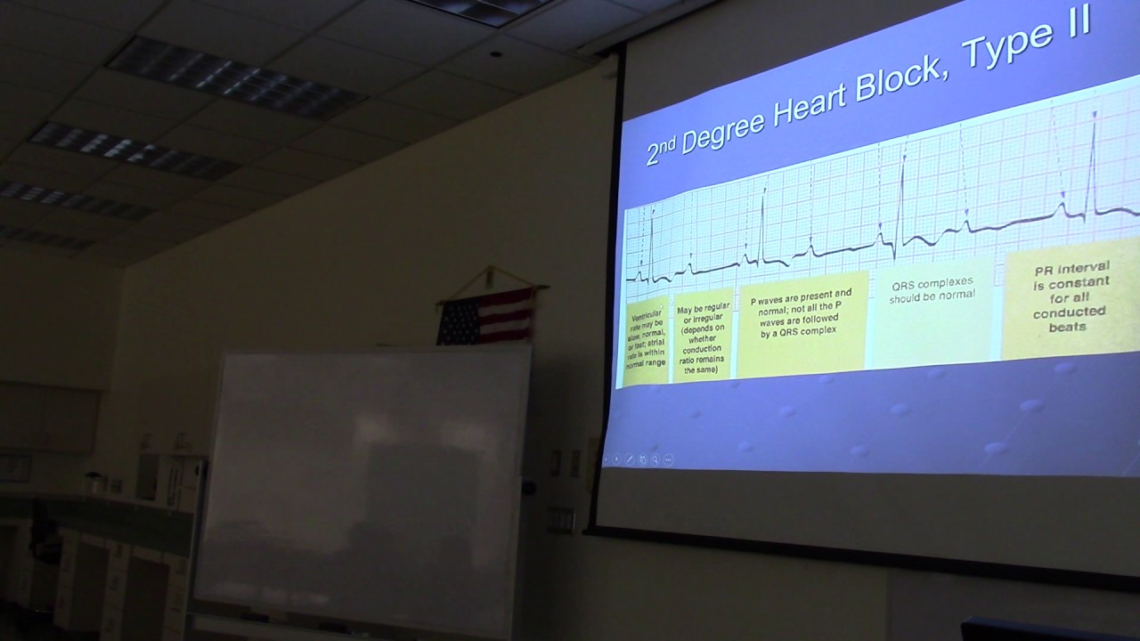 Heart Blocks Pacemaker Rhythms Part 1 Youtube