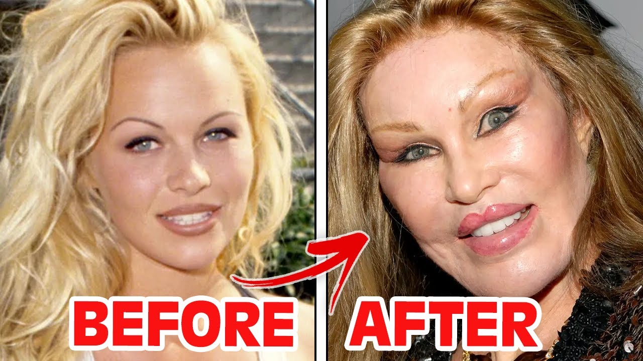Celebrity Plastic Surgery Before After Infoupdate Org