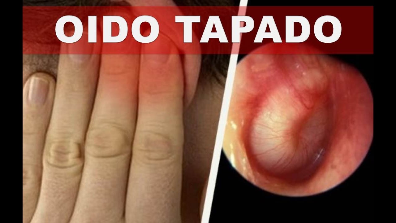 Como Reducir Un Oído Tapado En Casa Y Naturalmente Con Estos