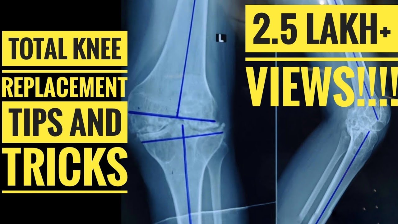 Total Knee Replacement Surgery Step By Step At Will Cobb Blog