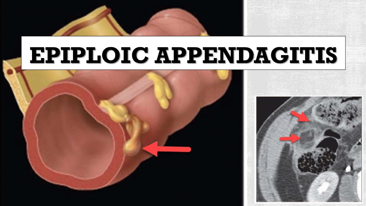 Epiploic Appendagitis Youtube