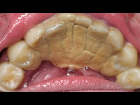 Heavy Calculus Tartar Removal Dental Calaculus Removed With