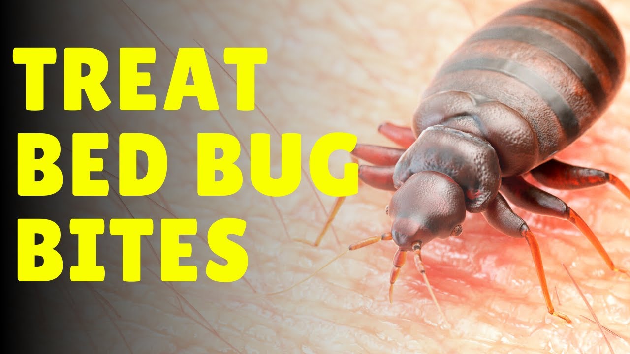 How Do You Prevent Bed Bug Bites At Sandra Karcher Blog