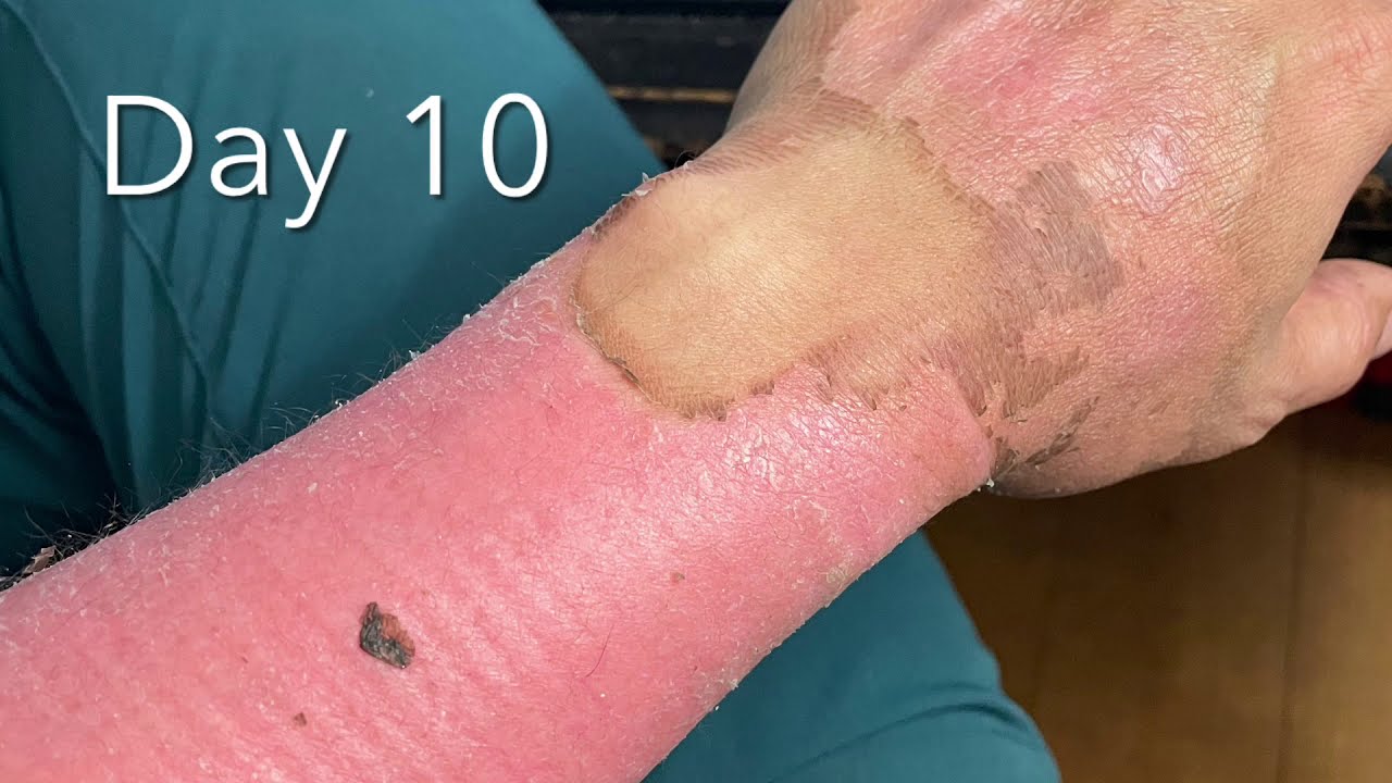 Healing Progress Of Second Degree Burns Youtube