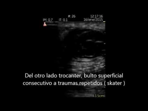 Necrosis Grasa Encapsulada Ecografia De Partes Blandas En Urgencias
