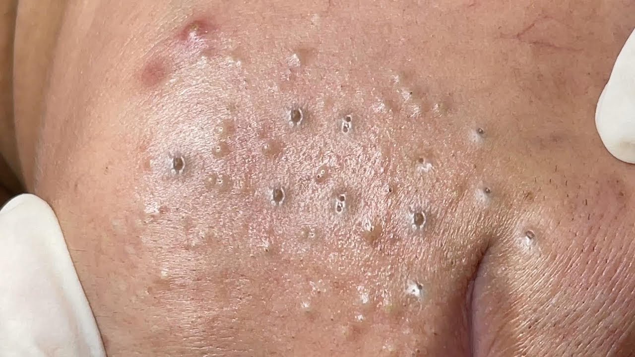 Make Your Acne Treatment Acne Spa 131 Sac Dep Spa Youtube