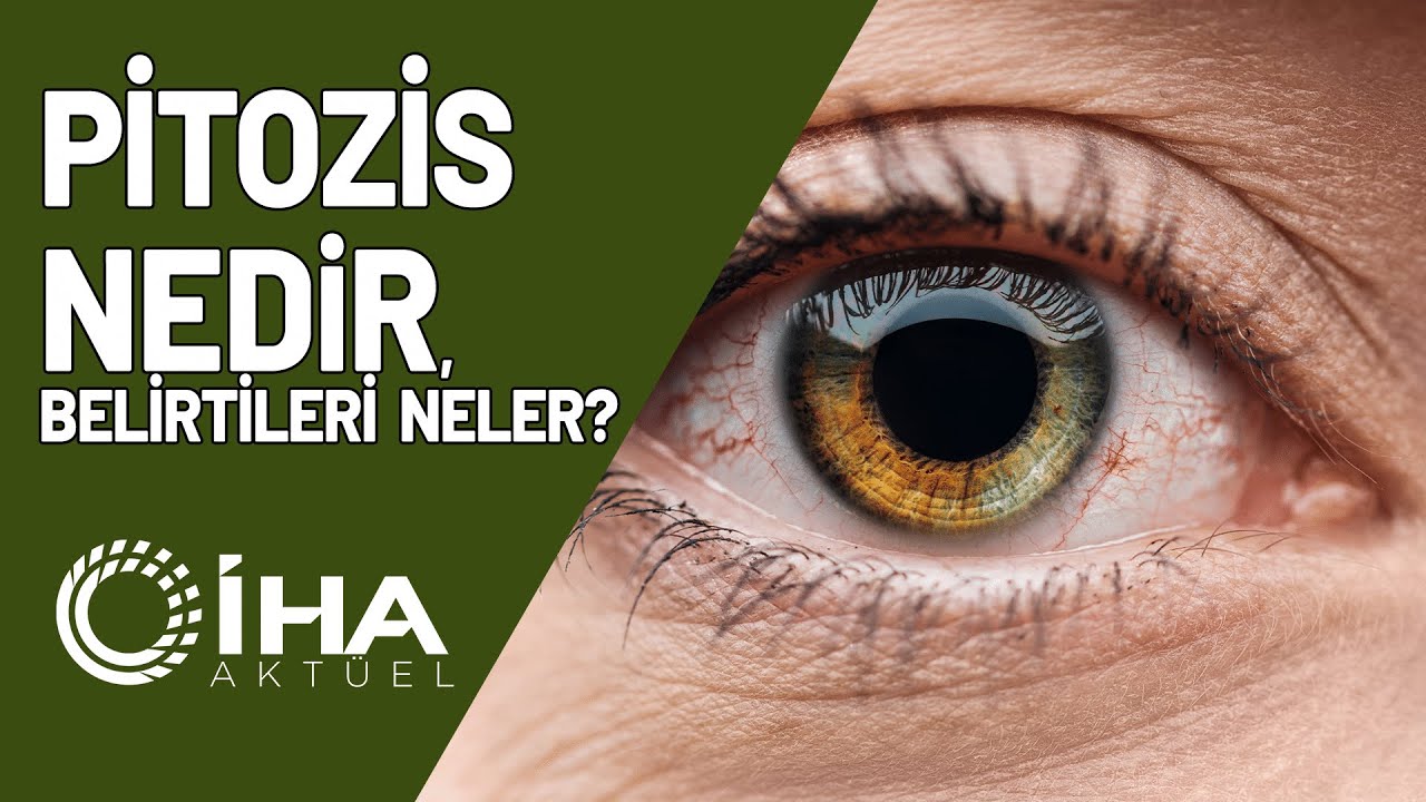 Pitozis Nedir Belirtileri Nelerdir Youtube