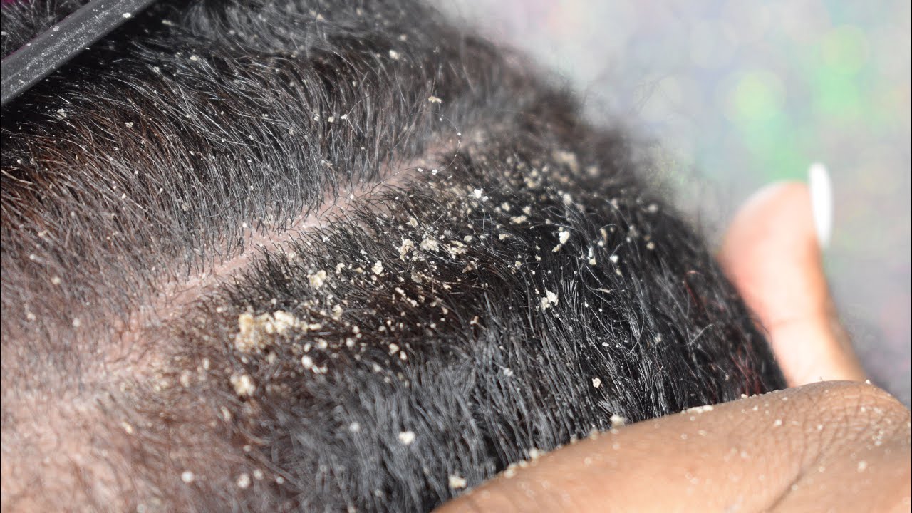 Dry Flaky Scalp Dandruff Scratching Asmr Ep12 Youtube