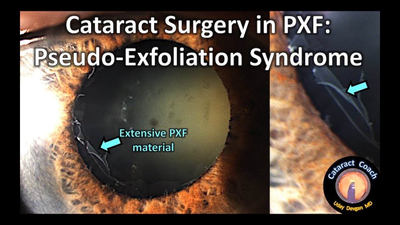 Cataract Surgery Eyes With Pseudoexfoliation Syndrome At Jonathan
